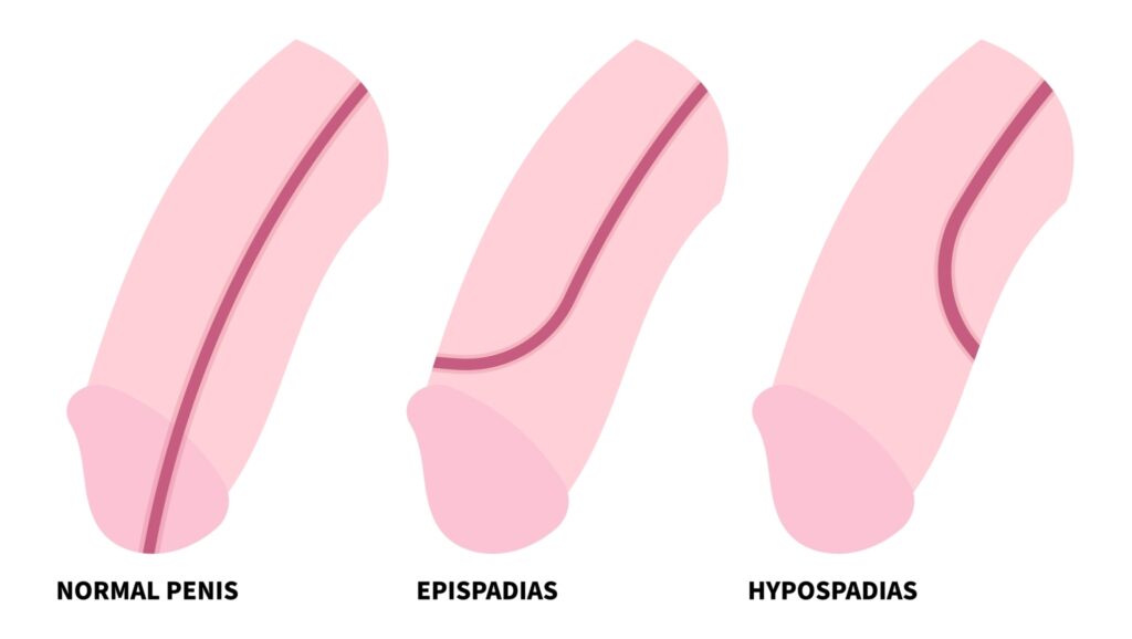 Hypospadias / Epispadias - drazharuddinpatel